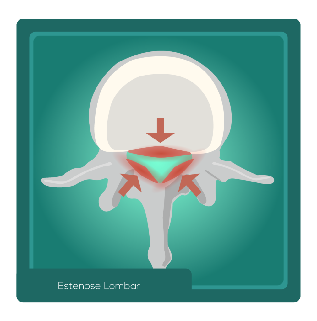Estenose do canal vertebral - Dr. Bruno César Aprile