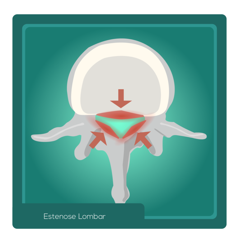 Estenose do canal vertebral - Dr. Bruno César Aprile